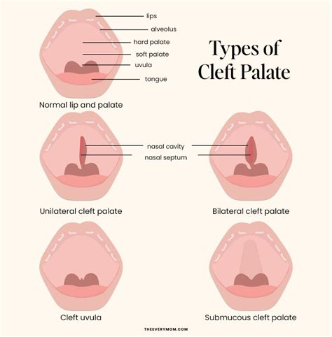 Experts Answer Questions About Cleft Lip And Cleft Palate Surgery