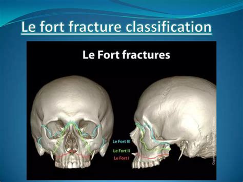 Le Fort Fracture2 Pptx