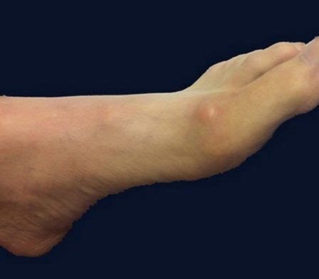Foot Ganglion Cyst Risks Ultrasound Guided Aspiration Of Ganglion
