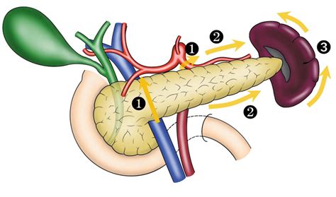 Distal Pancreatectomy
