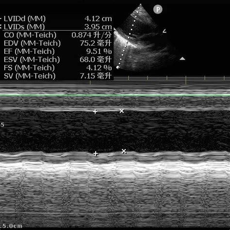 Ct Scan At Admission Showing Diffuse Multiple Ground Glass Opacities In Download Scientific