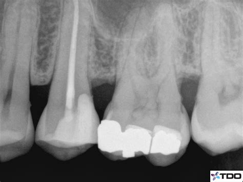 Endodontic Preparation Techniques The Endospot