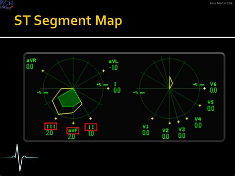 Ppt Beyond Arrhythmias St And Qt Segment Monitoring Powerpoint Presentation Id2884540 Ppt Beyond Arrhythmias St And Qt Segment Monitoring Powerpoint Presentation Id2884540