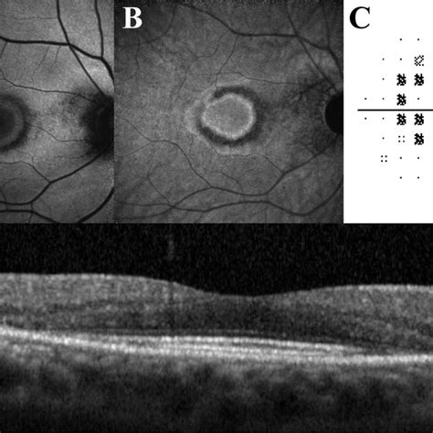 Patients With Abnormalities Noted In Sd Oct Imaging Six Patients A Download Scientific