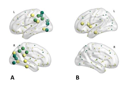 Malformations Of Cortical Development And Epilepsy A Gene And Brain Network Analysis