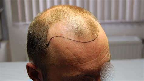 Difference Between Ringworm And Lyme Disease Rash