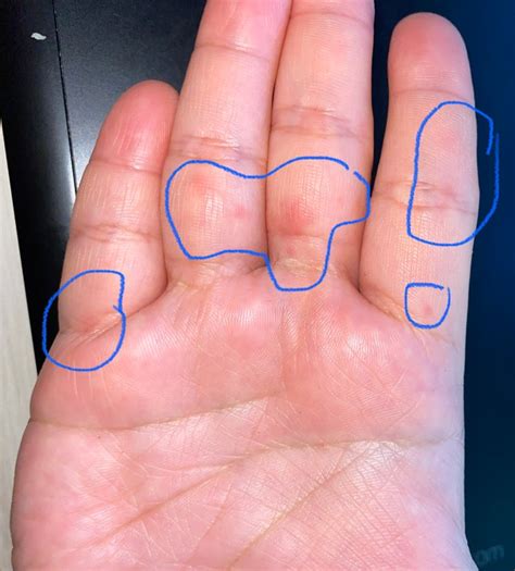 손바닥 발진 지식in