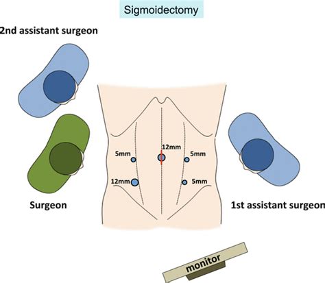 Laparoscopic Left Sided Colectomy Mobilization Of Splenic Flexure And