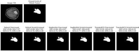 Transfer Learning Approaches For Brain Metastases Screenings