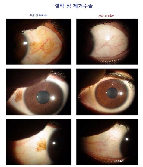 결막모반 제거 위례밝은성모안과의원