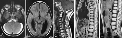 Initial Mri Of The Whole Craniospinal Axis At The Time Of Presentation