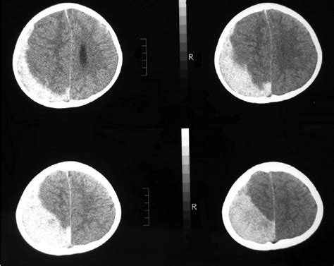 Axial View Of The Large Hyperdense Parietooccipital Subdural Hematoma