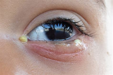 Crusty Eyes In The Morning What To Do About That Sticky Mucus