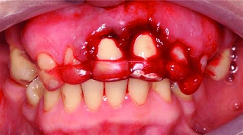 Modified Essix Retainer Fit Download Scientific Diagram