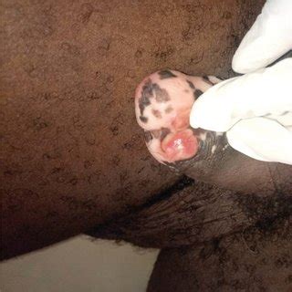 Patch Testing On Site Of Healed Lesions Download Scientific Diagram