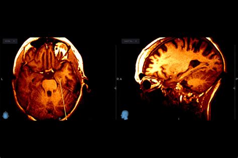 Frontiers In Epilepsy Treatment And Research