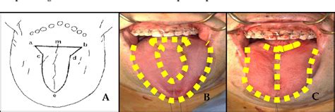 Figure 1 From The Efficacy Of The Partial Glossectomy For Prevention Of Airway Volume Reduction