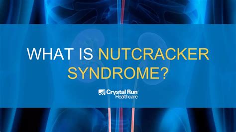 What Is Nutcracker Syndrome Pptx