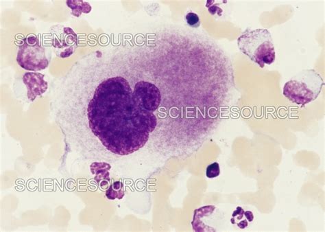 Bone Marrow In Thrombocytopenia Lm Stock Image Science Source Images