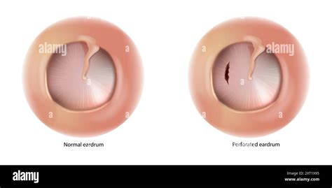 Ruptured Eardrum Or Hole In The Eardrum Perforated Eardrum And Normal Eardrum Stock Vector