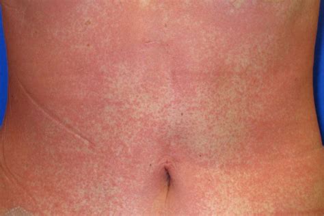 11 Types Of Drug Rash And Medications That Can Cause Them