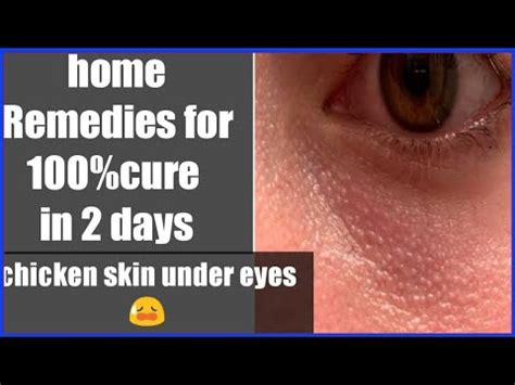 Chicken Skin Treatment Home Remedies Youtube