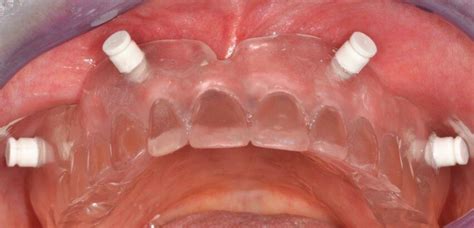 Radiographic Template With Radiopaque Landmarks Made From A Duplicate Download Scientific
