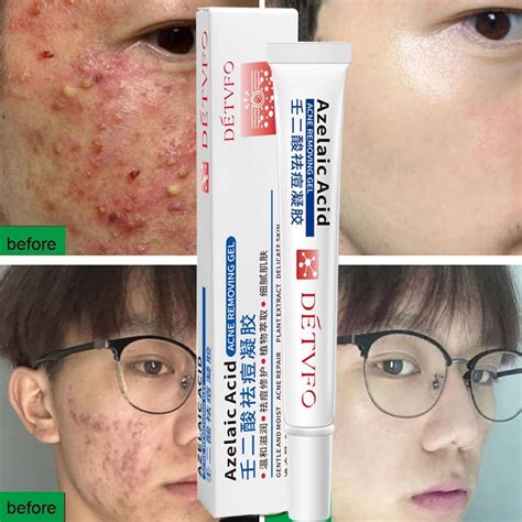 Hmtoot Azelaic Acid Anti Acne Gel Melasma And Dark Spots South Africa