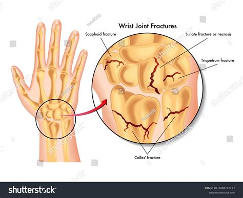 Scaphoid Fossa Wrist