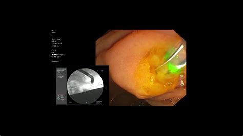Ercp Hard Stricture Of Hilar Cholangiocarcinoma Youtube