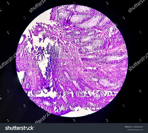 Hyperplastic Polyp Serrated