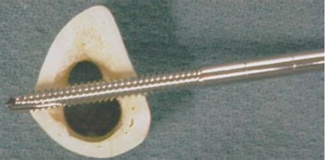 Femur The Use Of External Fixators In The Acute Management Of Tibial Pilon Fractures