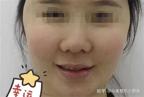 为何明星也难逃馒化脸过度填充导致的馒化如何修复 知乎