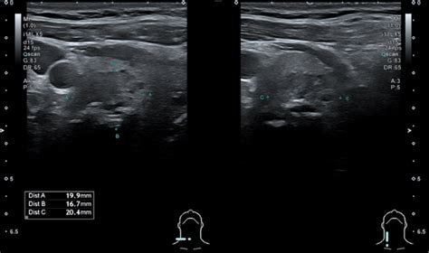 Hypoechogenic Ovoid Smooth Non Homogeneous Solid Thyroid Nodule With