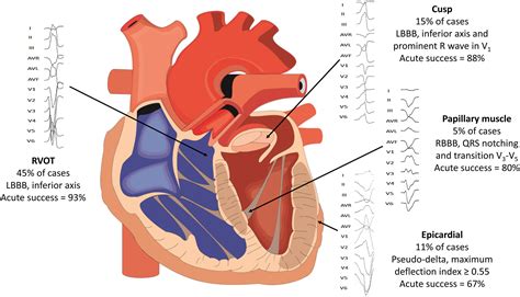 When To Consider Ablation For Premature Ventricular Complexes