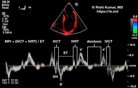Myocardial Performance Tei Index With Doppler Tissue Imaging Dti