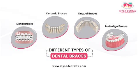 Different Types Of Dental Braces
