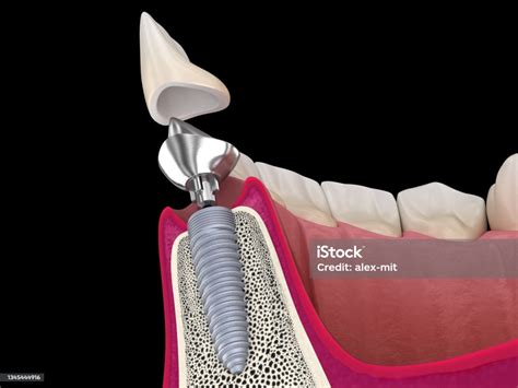 맞춤형 임플란트 부속 치과 임플란트 및 세라믹 크라운 의학적으로 정확한 치아 3d 그림 건강관리와 의술에 대한 스톡 사진 및 기타 이미지 Istock