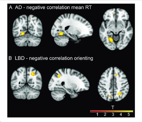 Significant Clusters From Voxel Based Morphometry Vbm Analysis A Download Scientific