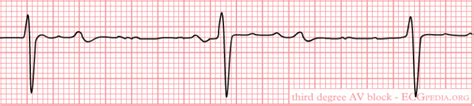 Telemetry And Ekg Basics Rhythm Recognition