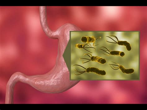 Lower Rates Of Symptom Rebound Seen After H Pylori Eradication In Ger