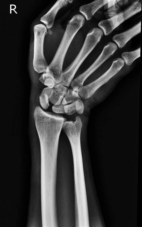 Radiopaedia Case Trans Scaphoid Lunate Dislocation Id 46217 Study