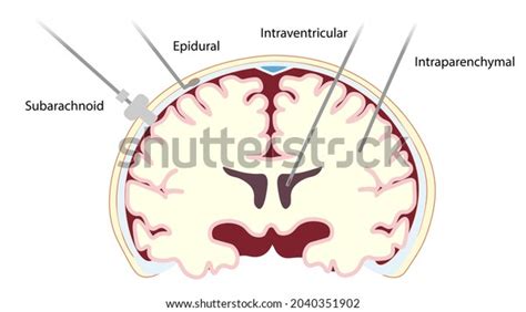 Icp Brain Photos And Images And Pictures Shutterstock