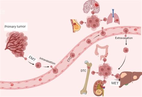 癌症转移三阶段 知乎