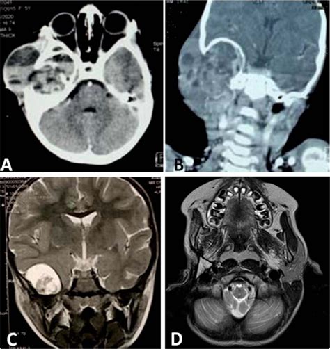 CT Scan Shows A Cystic Process Of The Middle Ear Cavities With A Download Scientific Diagram