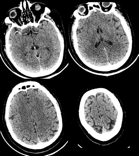 18 Non Contrast Ct Head Chss Elearning