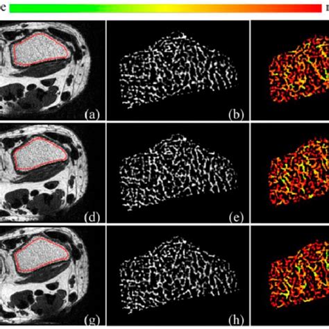 A Trabecular Bone Platerod Classification Of Trabecular Bone Using