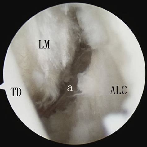 Modified Arthroscopic Brostrom Procedure Of The Left Ankle A The Download Scientific Diagram