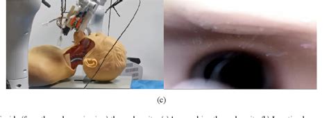 Figure 1 From Surgical Robotic System For Endotracheal Intubation Based On Laryngeal Mask Figure 1 From Surgical Robotic System For Endotracheal Intubation Based On Laryngeal Mask