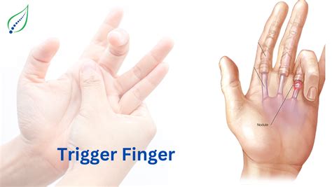 Trigger Finger Causes Symptoms And Treatment Options Best Back